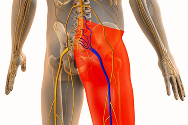Lifestyle Changes for Sciatica Relief: Causes and Solutions